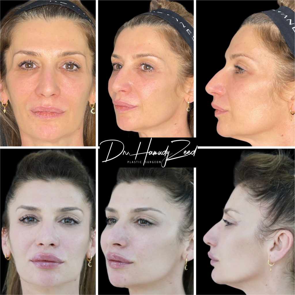 Before and After – facial and body aesthetics surgical and non surgical
