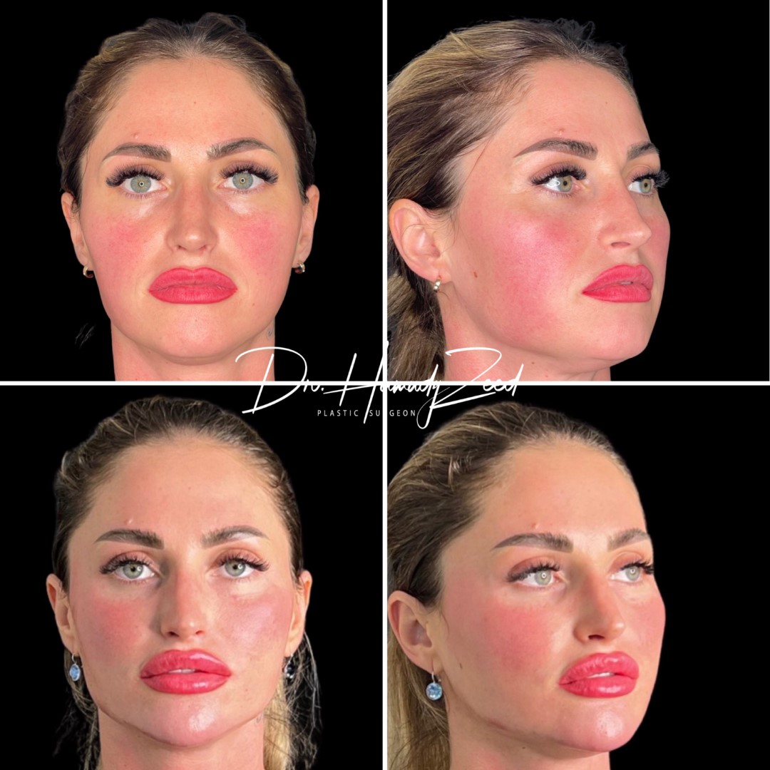 Mid-face, cheeks and eyes – facial and body aesthetics surgical and non ...